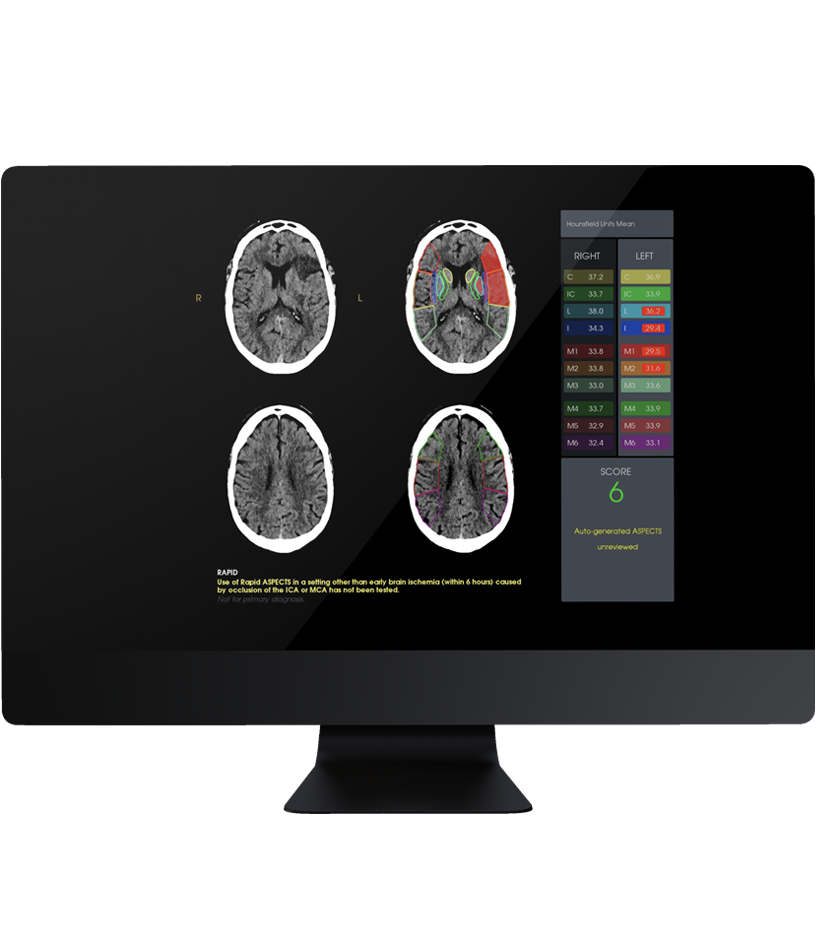 On-Demand WEBINAR: Discover Automated ASPECT Scoring: The Clinical ... On-Demand WEBINAR: Discover Automated ASPECT Scoring: The Clinical ...